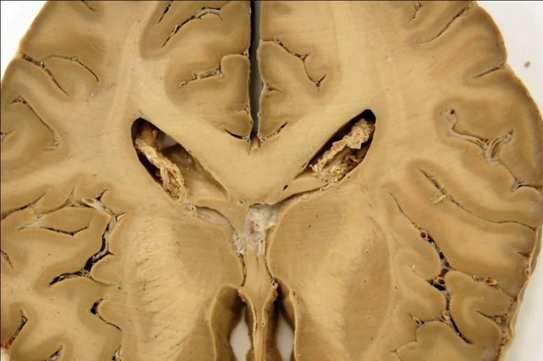 Low-temperature dehydration and room-temperature impregnation of brain ...