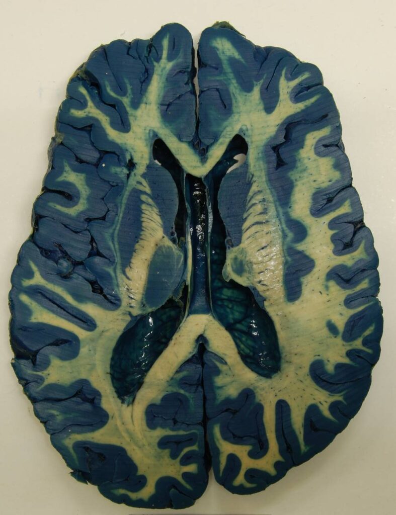 Low-temperature dehydration and room-temperature impregnation of brain ...