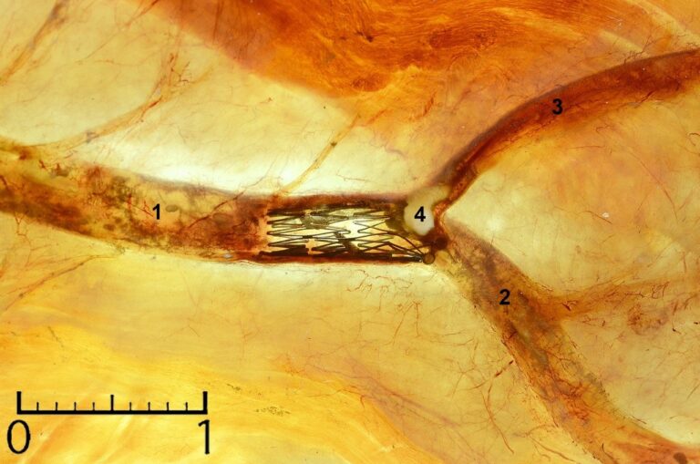 Visualization of Metal Stents in Coronary Arteries with Epoxy ...