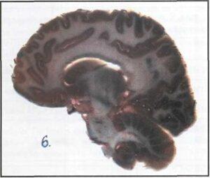 P40 Plastination of Human Brain Slices: Comparison between Different ...