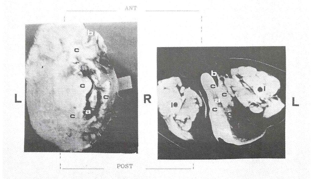 Comparative Analysis of a Plastination Specimen and Clinical Diagnostic ...