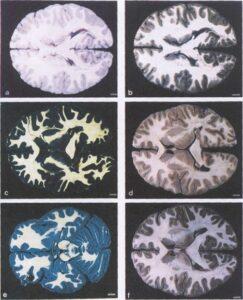Plastination of Stained Sections of the Human Brain: Comparison between ...