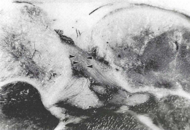 Demonstration of Neovascularization of Anterior Cruciate Ligament ...