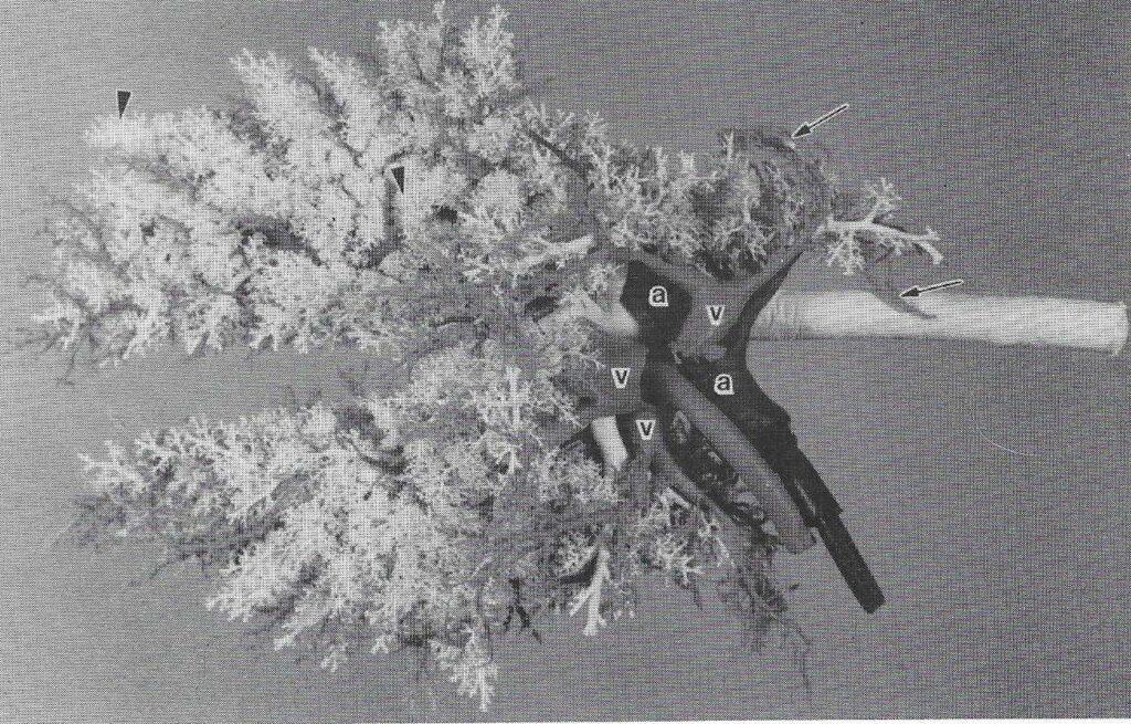 Silicone Pulmonary Vascular Casts With Attached Tracheobronchial Casts ...