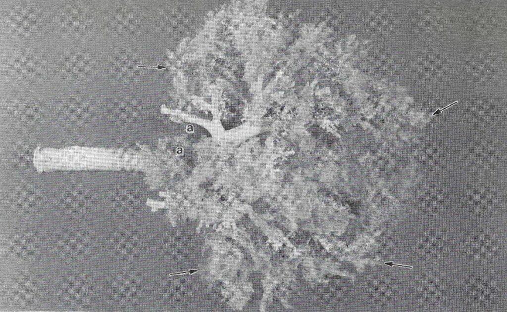 Silicone Pulmonary Vascular Casts With Attached Tracheobronchial Casts ...