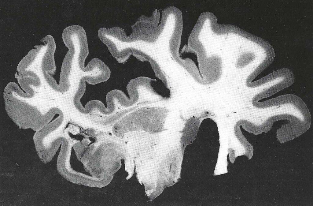 Staining of Human Fetal and Adult Brain Slices Combined with Subsequent ...