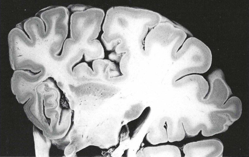 Staining of Human Fetal and Adult Brain Slices Combined with Subsequent ...