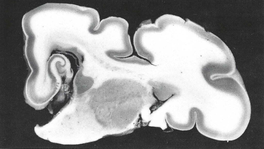 Staining of Human Fetal and Adult Brain Slices Combined with Subsequent ...